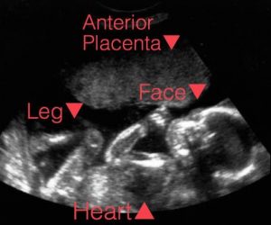 Normal 14 week baby ultrasound. - Ultrasoundfeminsider