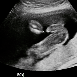 Normal 30 week baby ultrasound. - Ultrasoundfeminsider