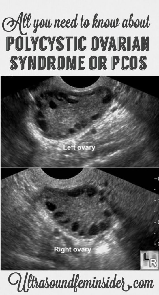 All about Polycystic ovarian syndrome or PCOS. - Ultrasoundfeminsider