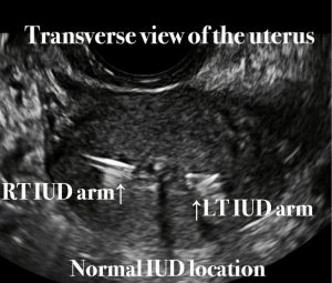 All about IUD or Intrauterine device. - Ultrasoundfeminsider