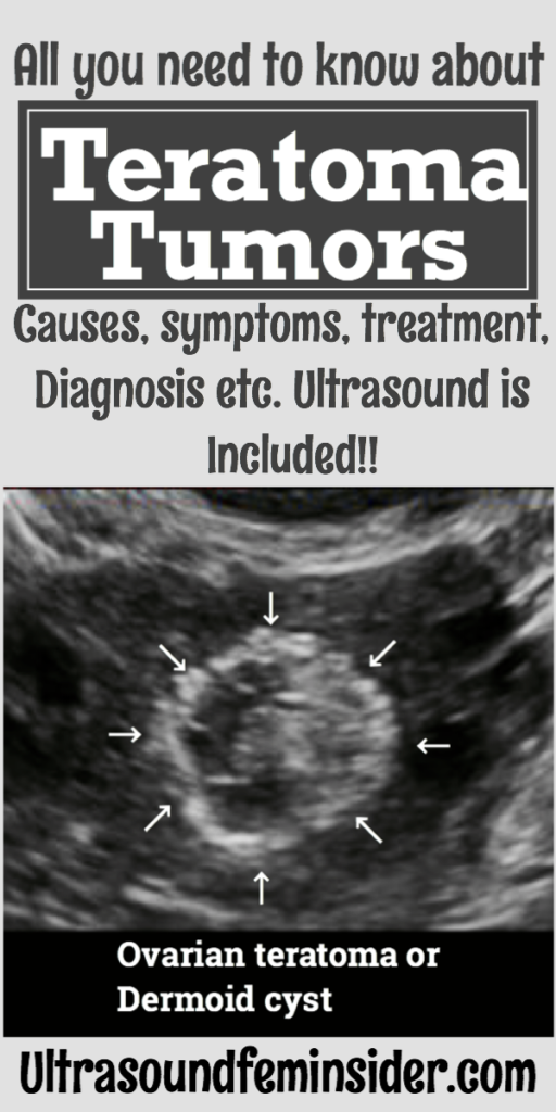 Teratoma. Causes, symptoms, diagnosis and treatment. - Ultrasoundfeminsider