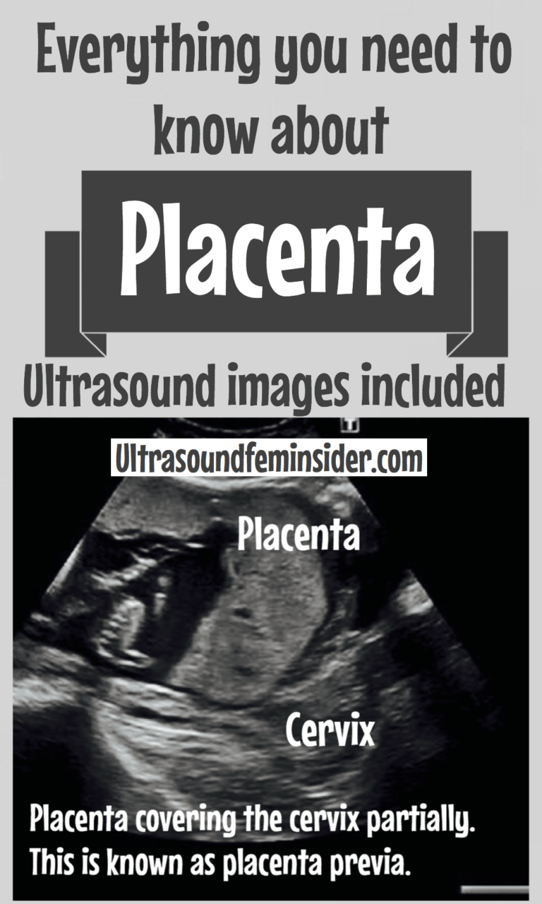 Everything about the placenta. Ultrasound included. - Ultrasoundfeminsider