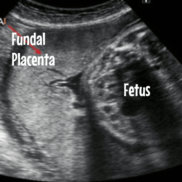 Everything about the placenta. Ultrasound included. - Ultrasoundfeminsider