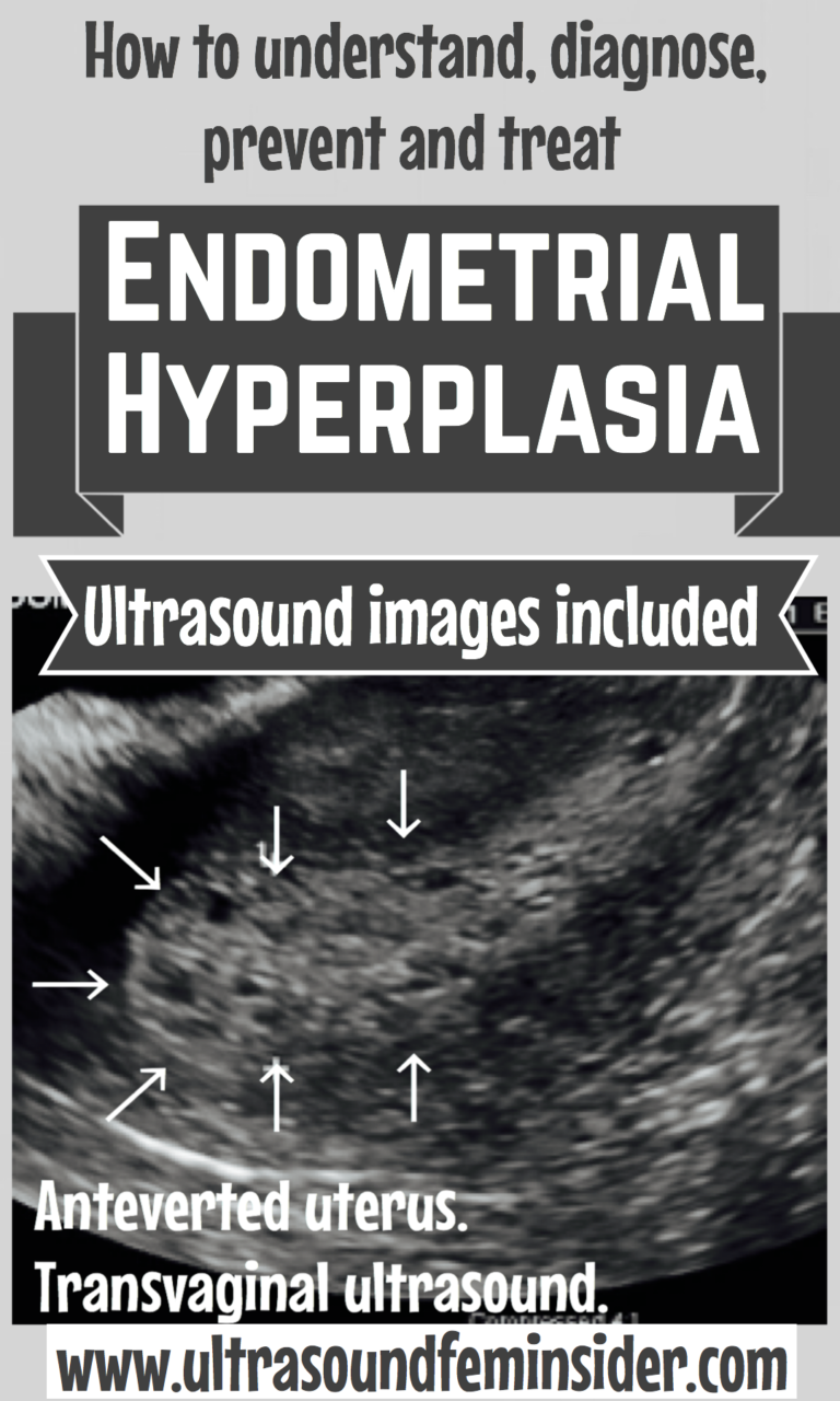 Endometrial hyperplasia. Causes, risks, ultrasound and treatment ...