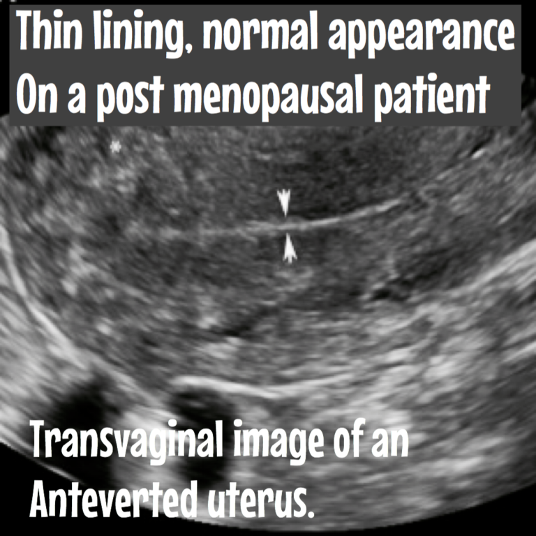 Endometrial hyperplasia. Causes, risks, ultrasound and treatment ...