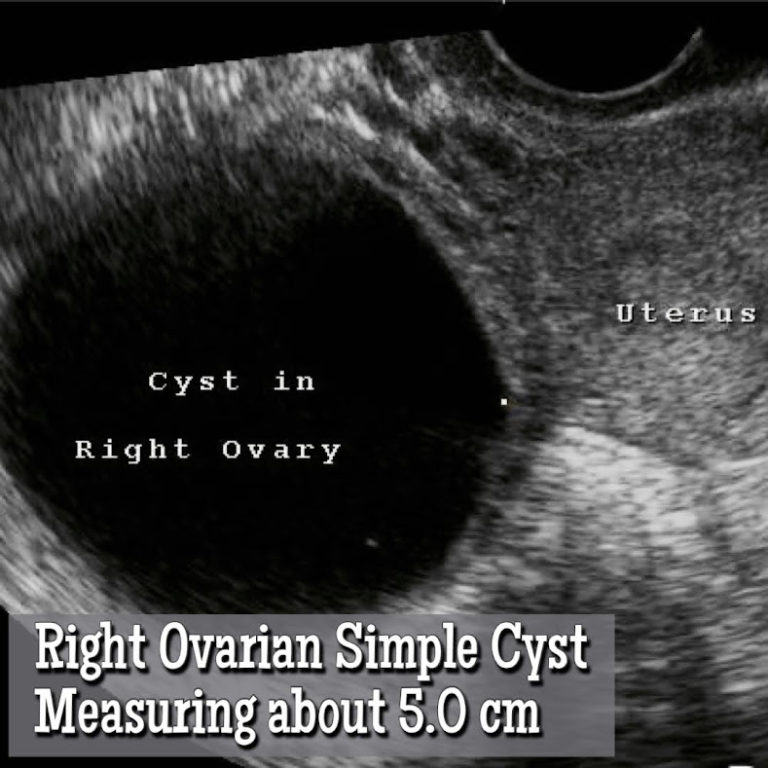 Ovarian Follicle Vs An Ovarian Cyst How To Tell The Difference
